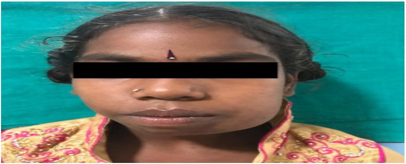 Ameloblastic Fibro Odontoma Associated with Odontogenic Keratocyst – A ...