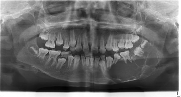 Ameloblastic Fibro Odontoma Associated with Odontogenic Keratocyst – A ...
