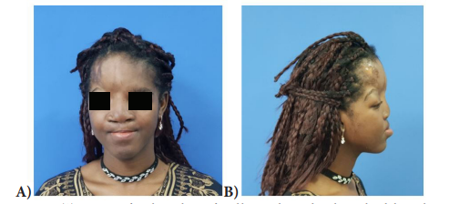 Single Stage Surgical Management of an Adult Patient with Crouzon ...